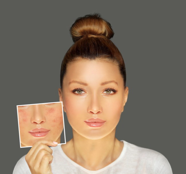 How To Use Hemp Acne Repair Gel